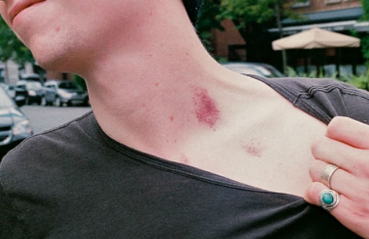 Teenager Dies From Hickey His Girlfriend Gave Him Complex