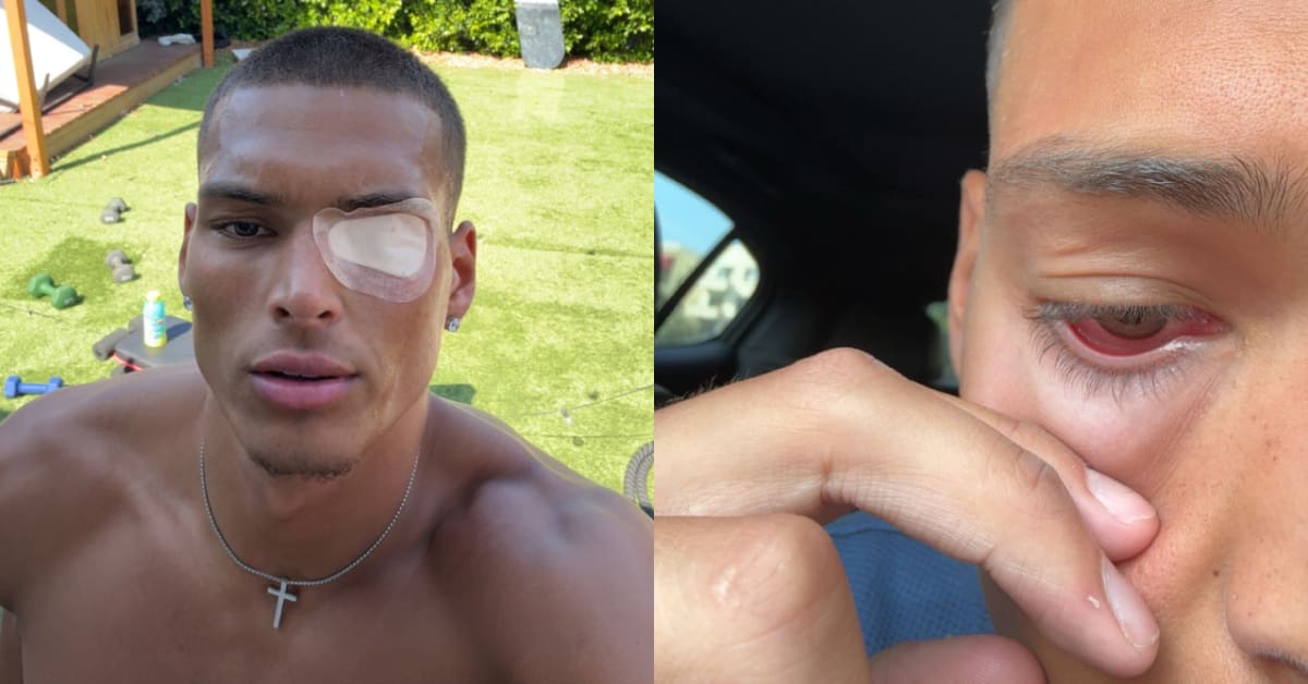 Marlon Says Gorilla Glue Got in His Eye and Doctors Unsur...