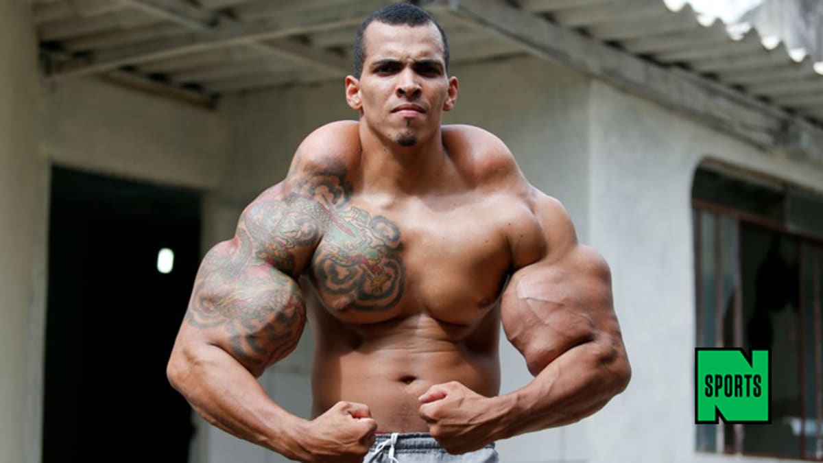 Brazilian Bodybuilder Nearly Has Arms Amputated After Turning Into Real-Life Hulk | Complex
