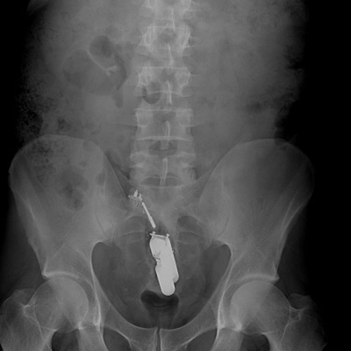 A Complete Guide To Things People Got Stuck Inside Of Their Bodies In 