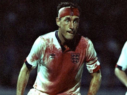 Terry Butcher - The Most Gruesome Sports-Injury Photos of All Time ...