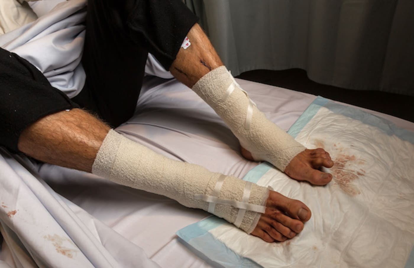 Flesh Eating Ulcer Disease Spreads In Australia Complex